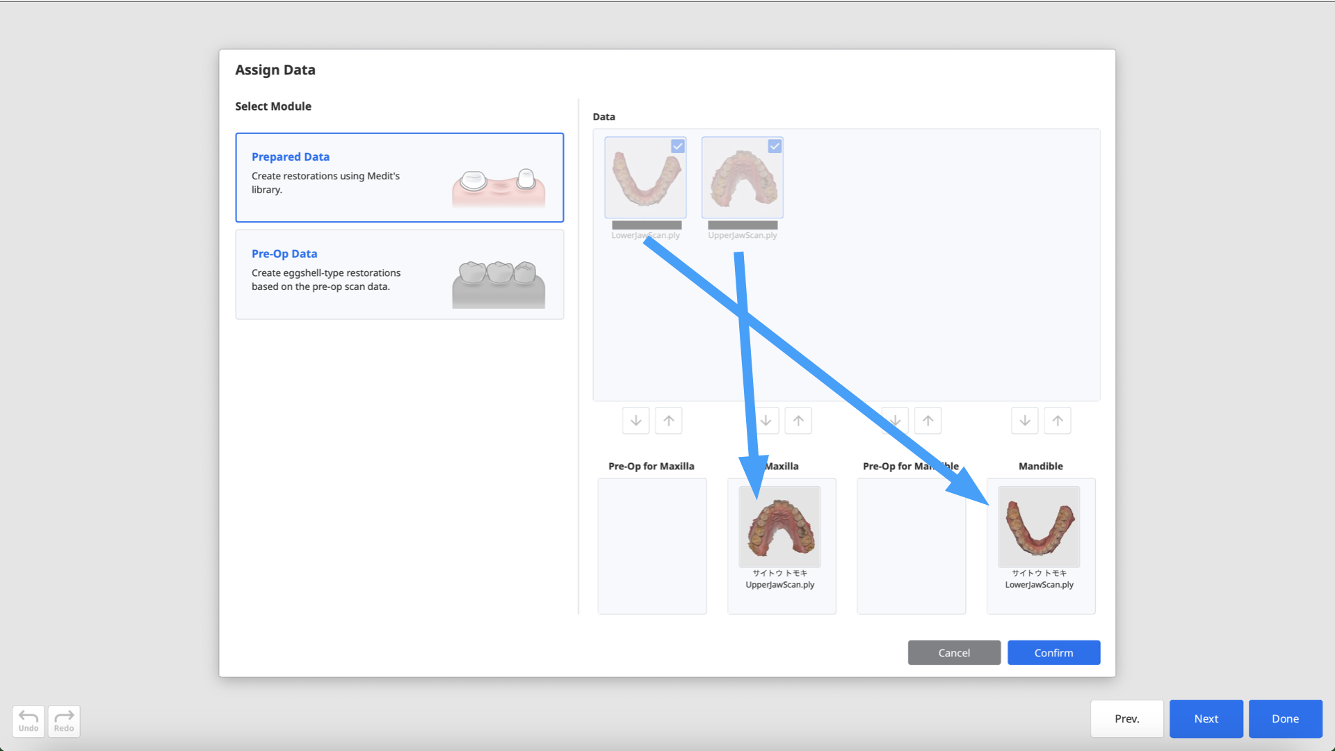 歯科用CADソフト、MeditLinkを使ってみよう③ Medit ClinicCAD[Inlay] - DDI