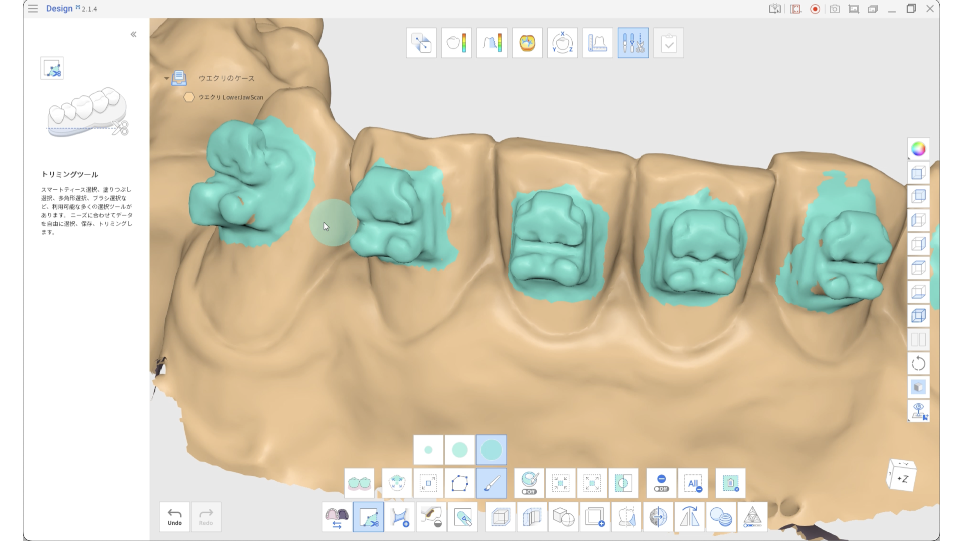 MeditLinkでstlデータ上のブラケットをはずしてみるーVirtual Bracket Removal - DDI